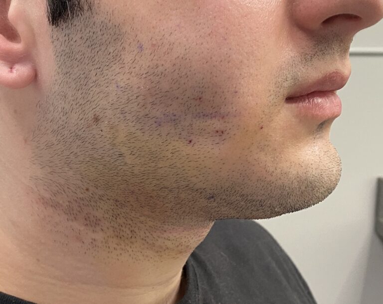 Technical Strategies - Bolster Dressing for Buccinator Myectomies and ...