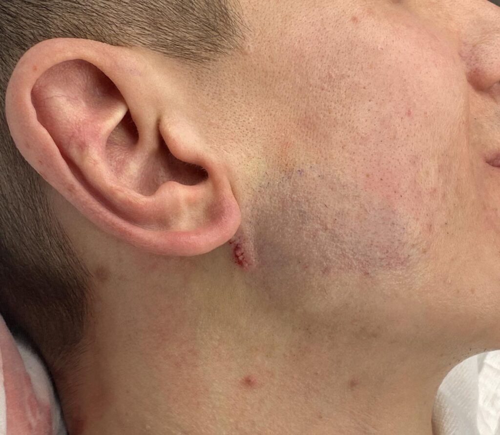 Plastic Surgery Case Study - Thick Allodem Graft For Soft Tissue ...