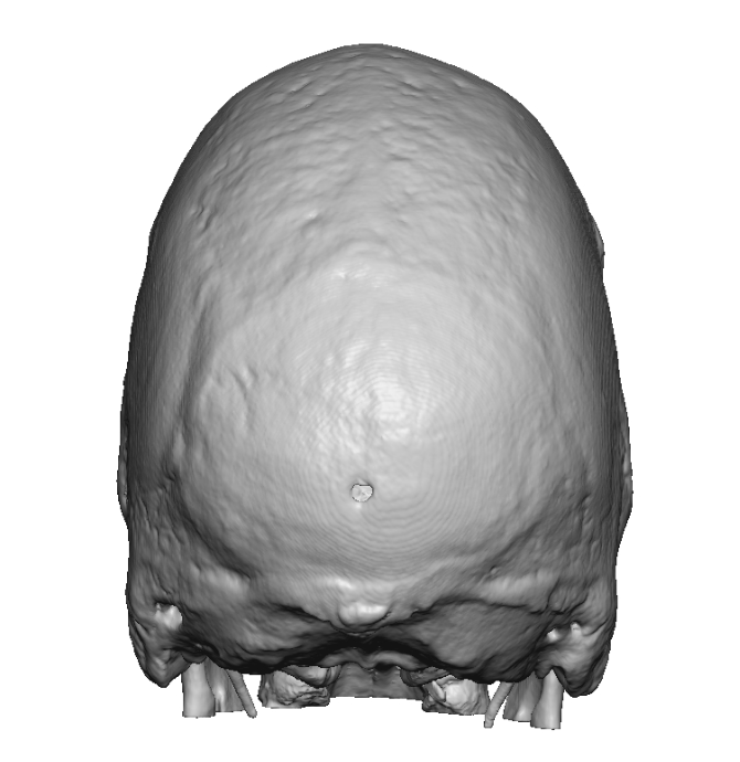 On Profile View The Scaphocephalic Head Has An Anteriorly