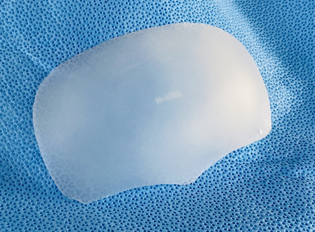 A New Off-The-Shelf Implant for Aesthetic Forehead Augmentation ...