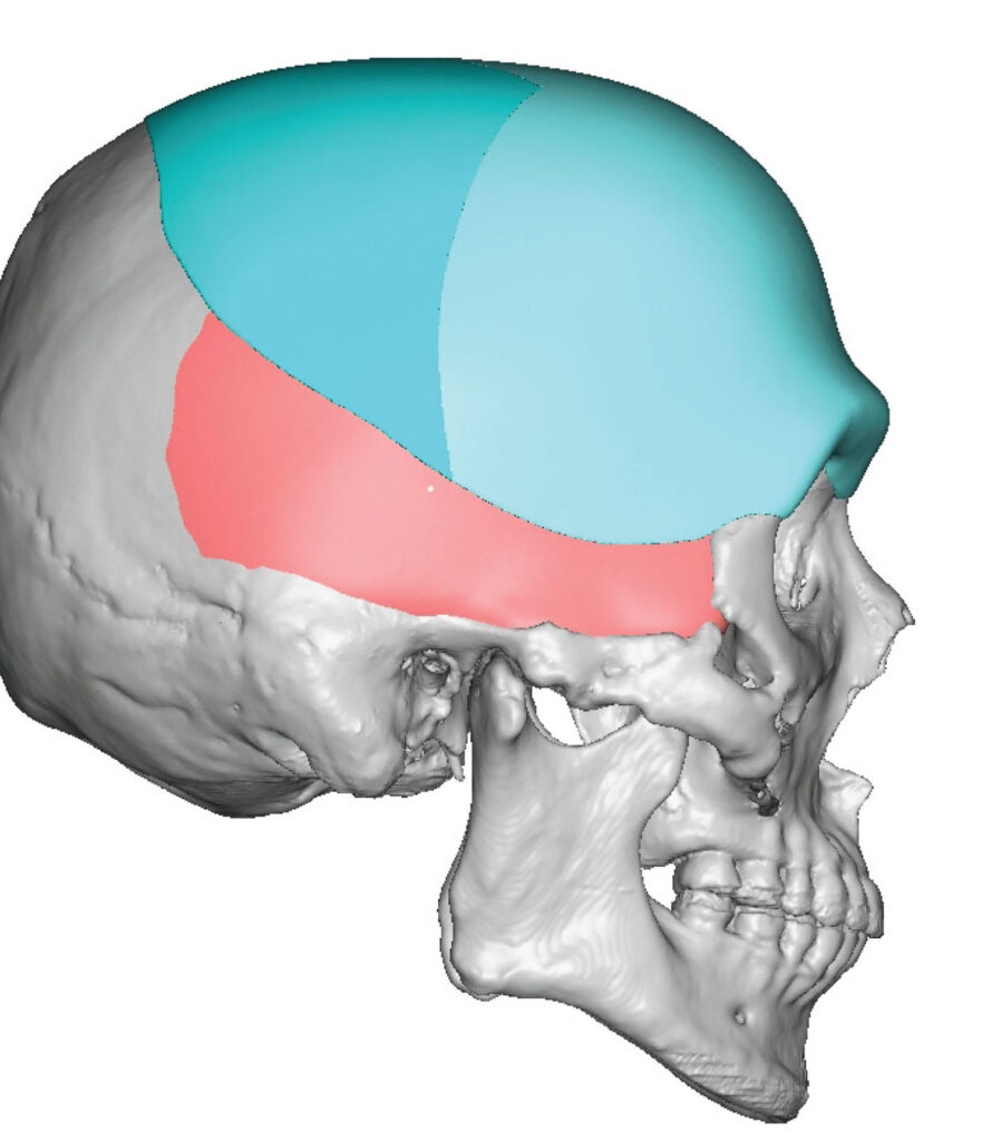 Plastic Surgery Case Study - Two Stage Custom Forehead Brow Bone ...