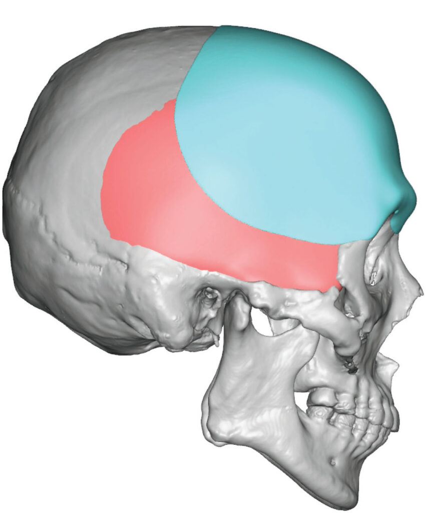 Plastic Surgery Case Study - Two Stage Custom Forehead Brow Bone ...