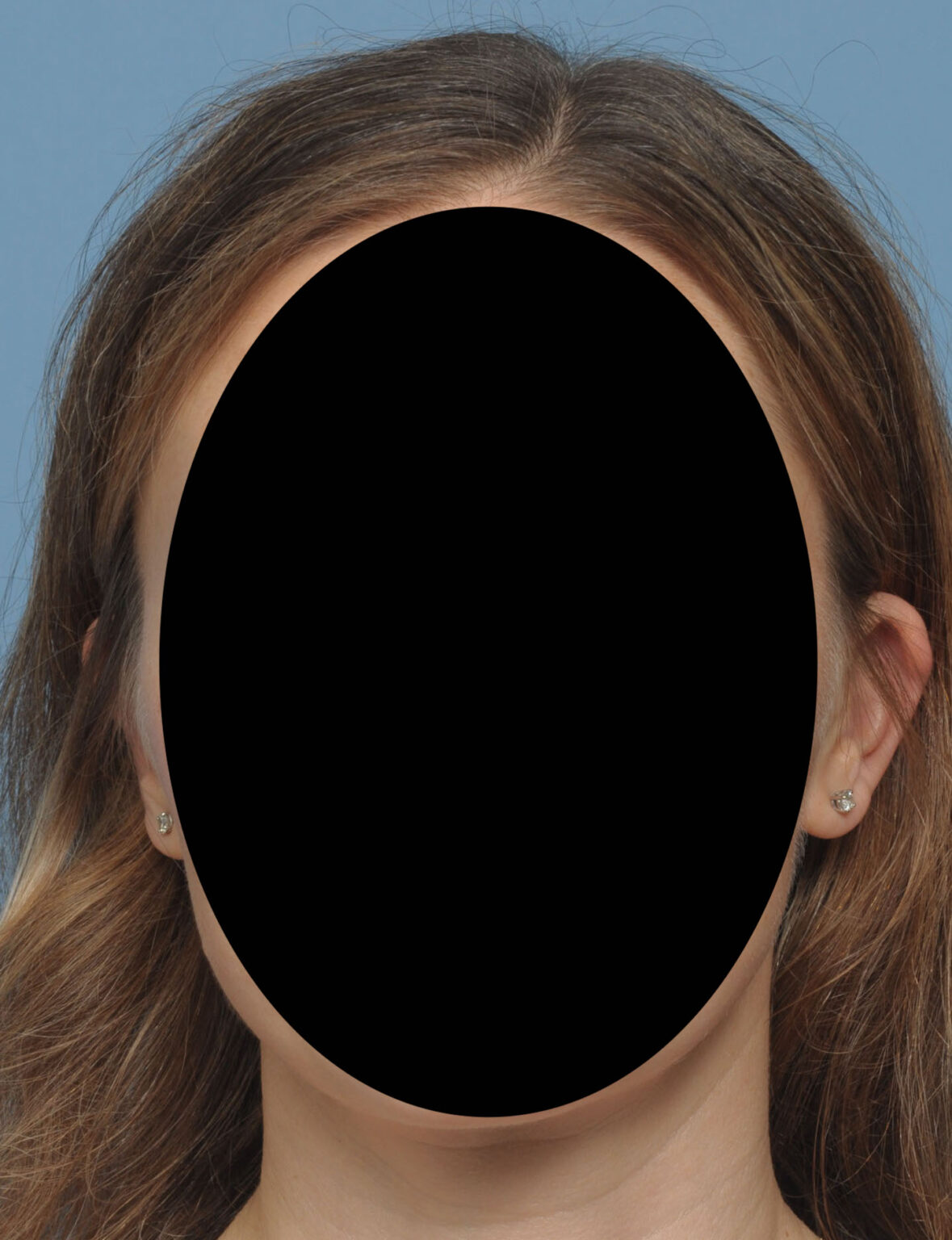 Plastic Surgery Case Study - Female Crown of the Head Augmentation with ...