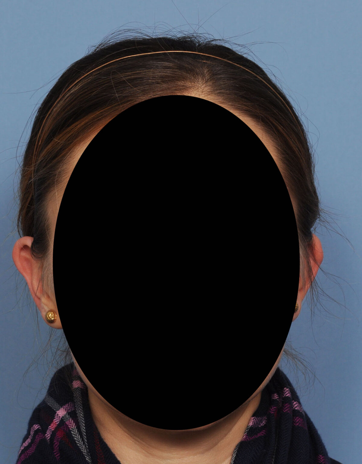 Plastic Surgery Case Study - Female Crown of the Head Augmentation with ...