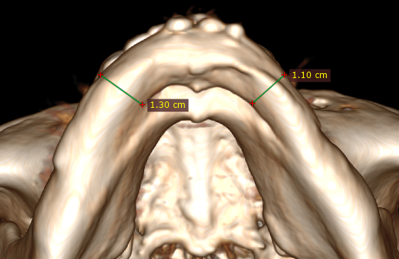 Plastic Surgery Case Study - Secondary Chin Reshaping after Sliding ...