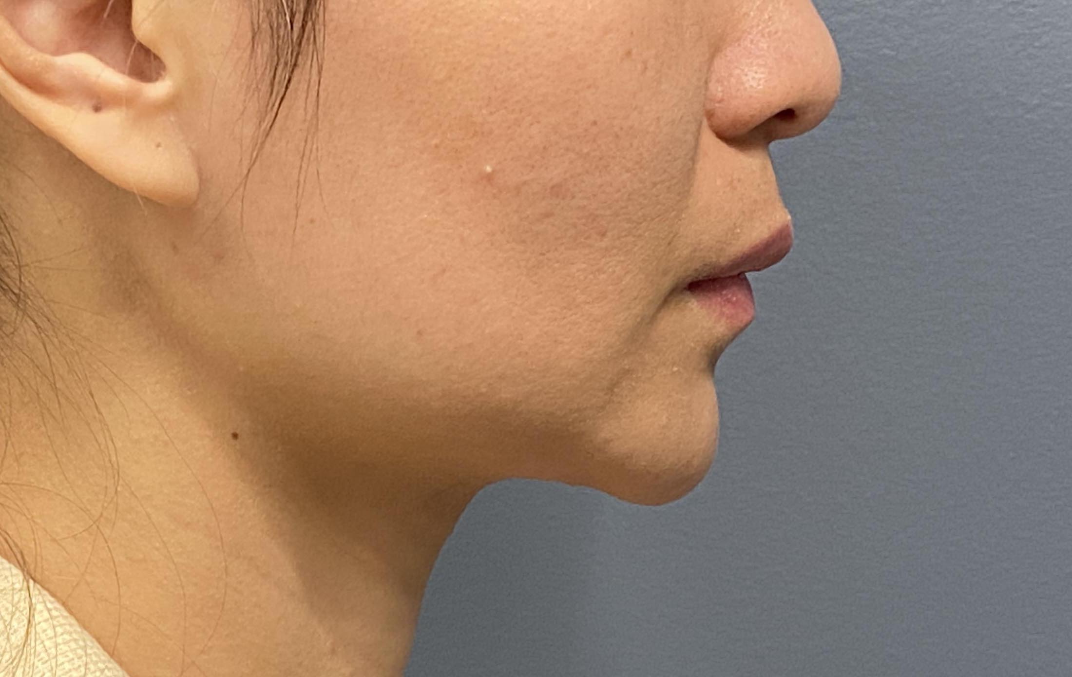 asian female chin implant replacement projection 1 Dr Barry Eppley copy ...