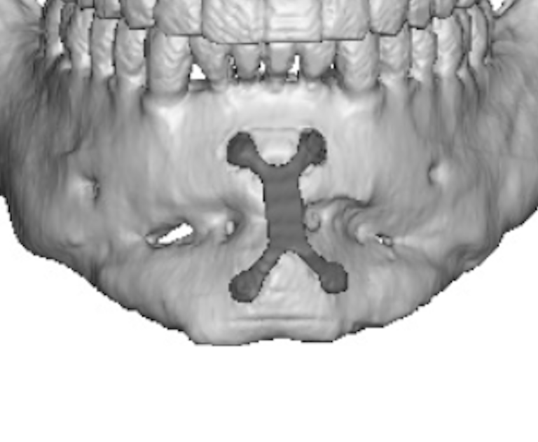 Assessment of Bone Healing Across The Grafts Interpositional Gap in ...