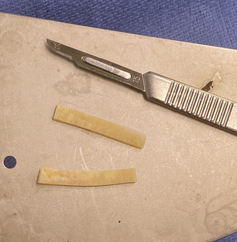 Plastic Surgery Case Study - Correction of Over Corrected Otoplasty ...