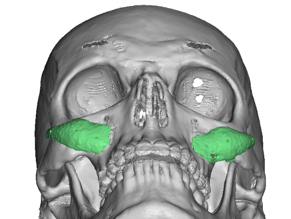 Technical Strategies - Treating the Cheek Implant Stepoff Deformity ...