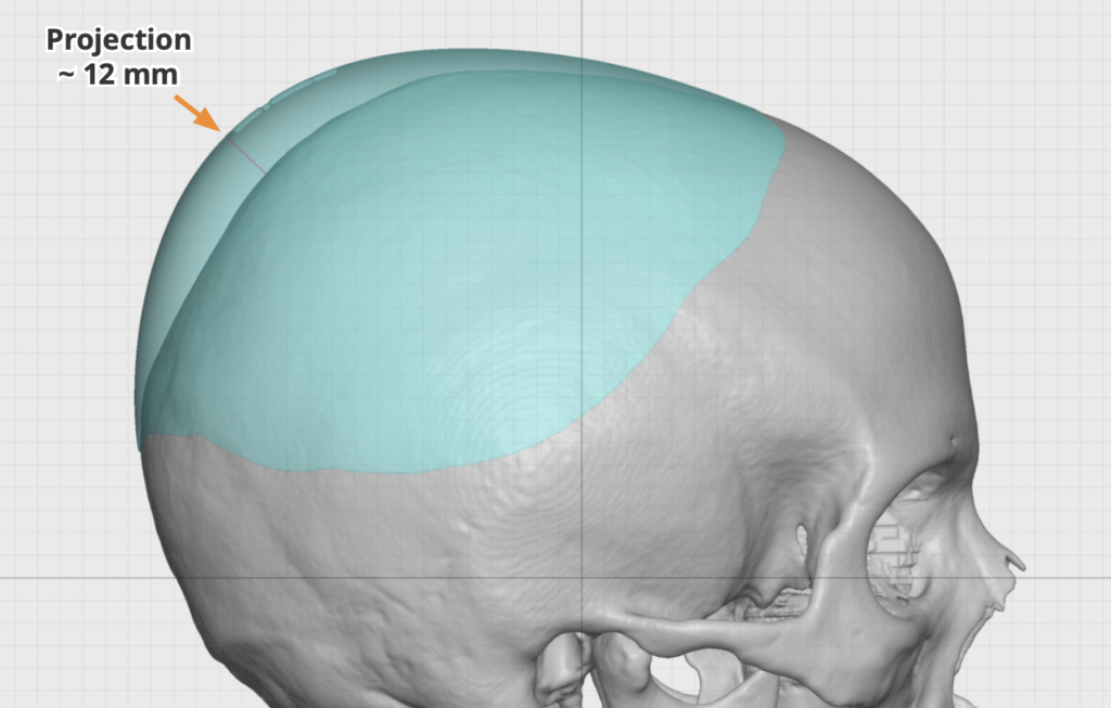 Plastic Surgery Case Study - Female Crown of the Head Augmentation with ...