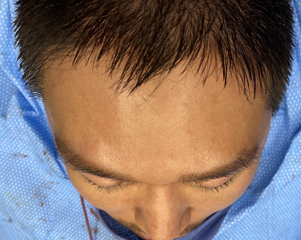 Plastic Surgery Case Study - Two Stage Custom Forehead Brow Bone ...