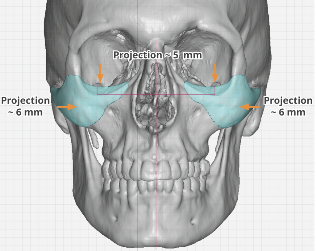 Plastic Surgery Case Study - Large Custom Infraorbital-Malar Implants ...