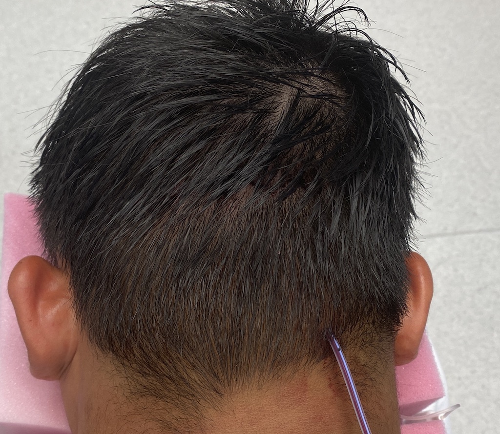 Plastic Surgery Case Study - Custom Back of the Head Skull Implant for ...