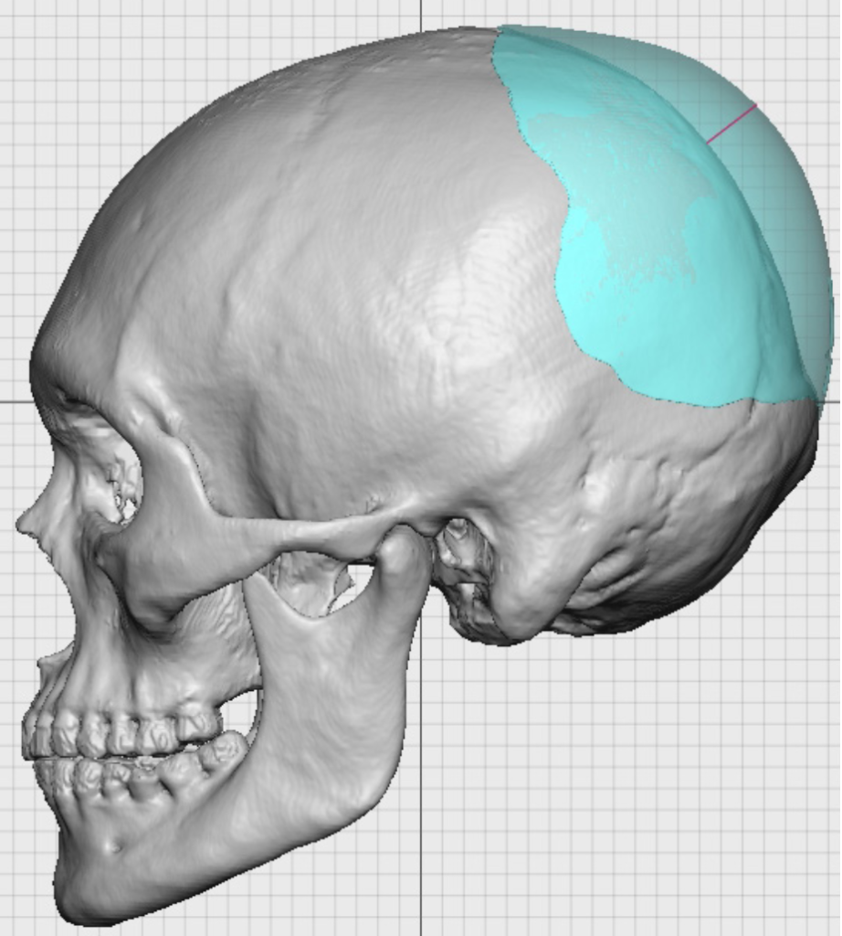 Plastic Surgery Case Study - Custom Back of the Head Skull Implant for ...