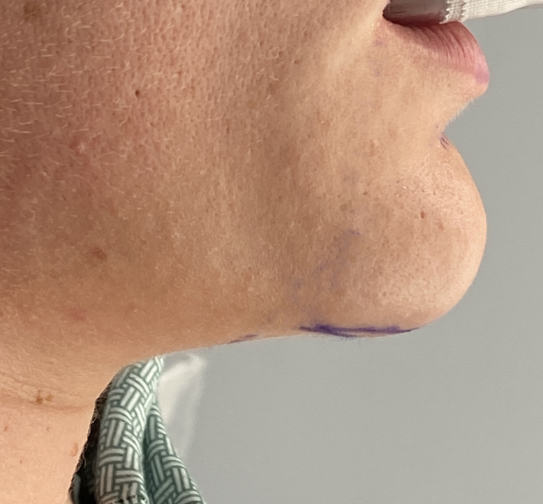 femal submental chin reduction side 1 Dr Barry Eppley - Explore Plastic ...