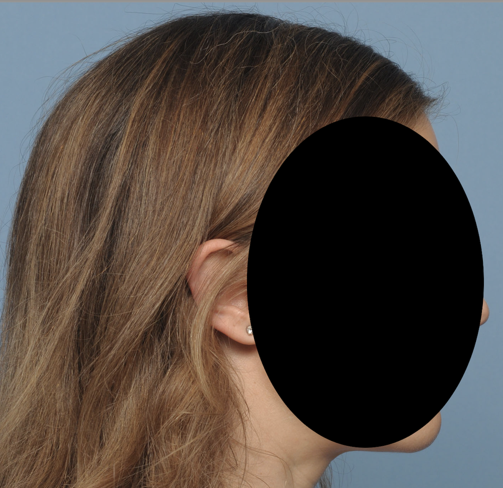 Plastic Surgery Case Study - Female Crown of the Head Augmentation with ...