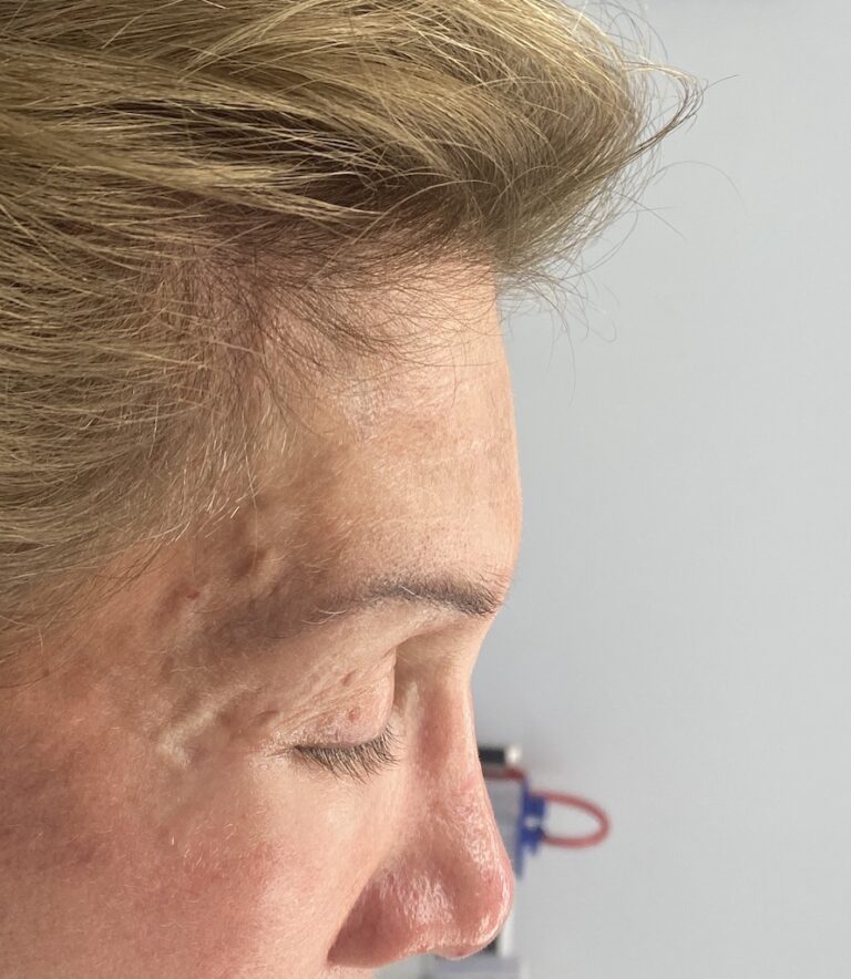 Plastic Surgery Case Study - Custom Forehead Implant for Improving the ...