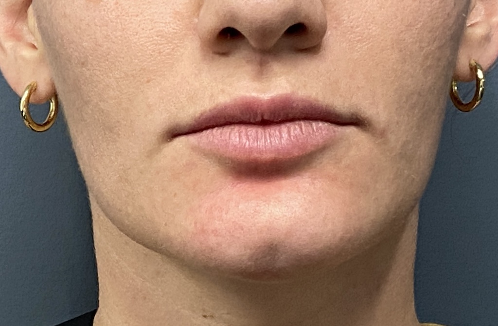 Plastic Surgery Case Study - Female Horizontal Chin Reduction with ...