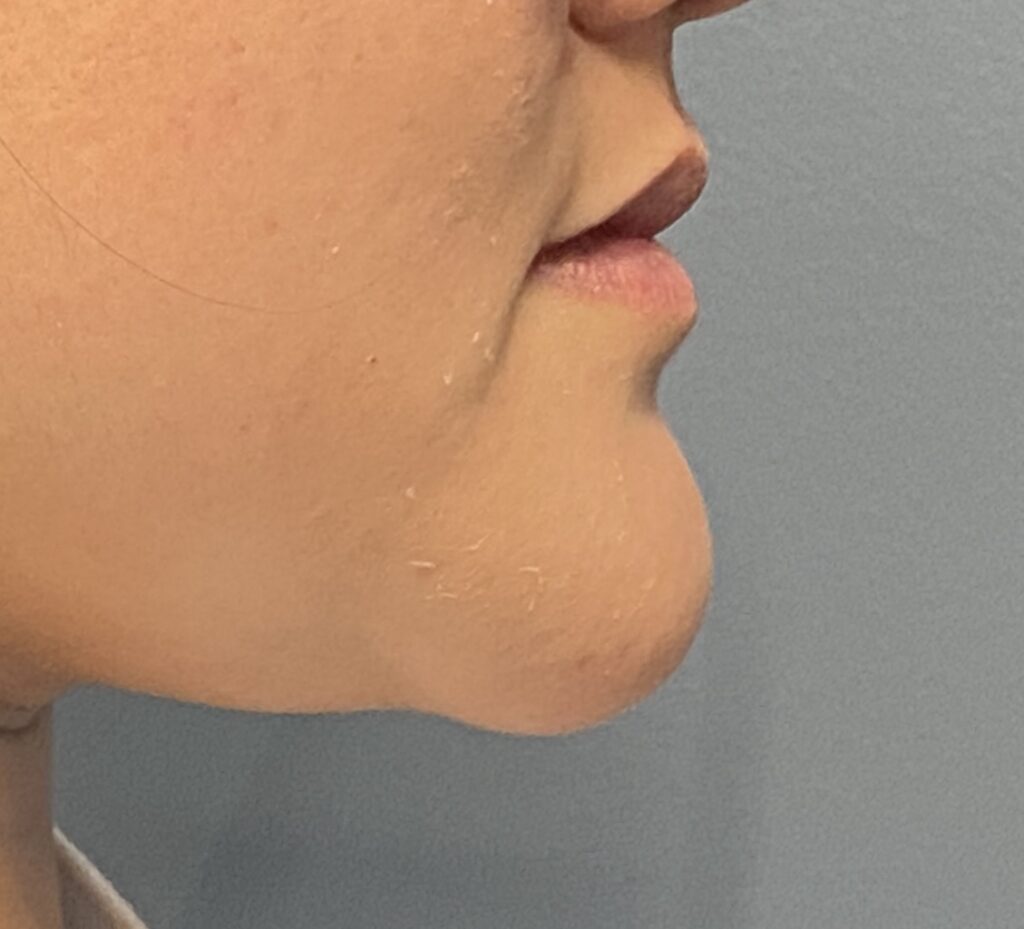 Plastic Surgery Case Study - Submental Excision/Tuck for Hyperdynamic ...