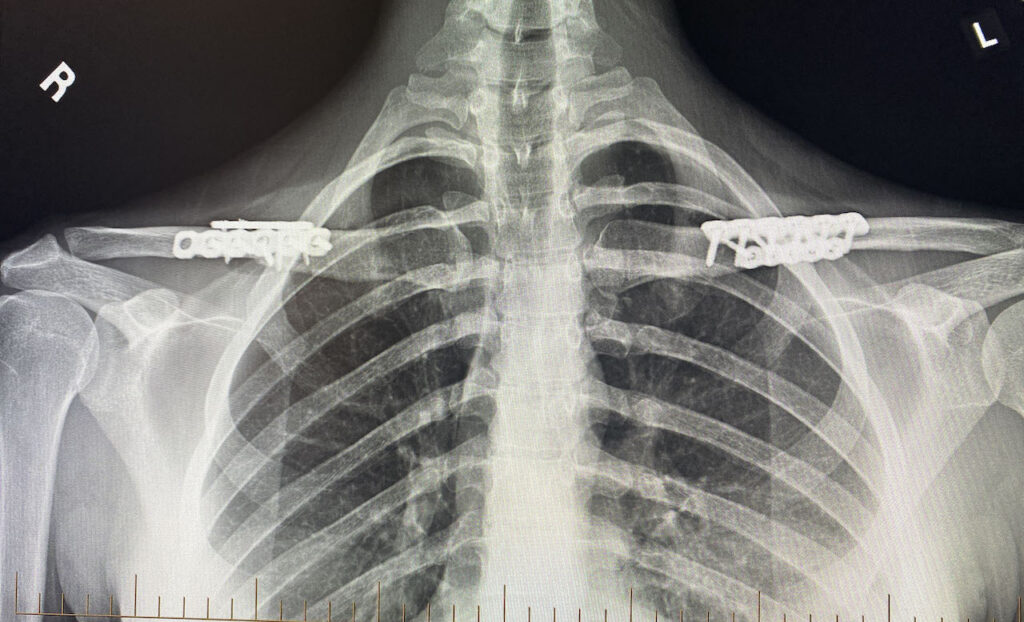 Plastic Surgery Case Study - Shoulder Narrowing in the Thin Clavicle ...