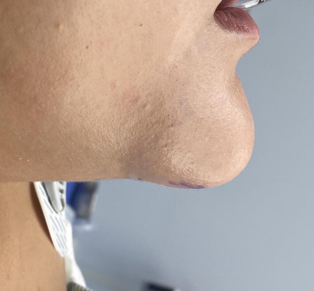 Plastic Surgery Case Study - Submental Excision/Tuck for Hyperdynamic ...