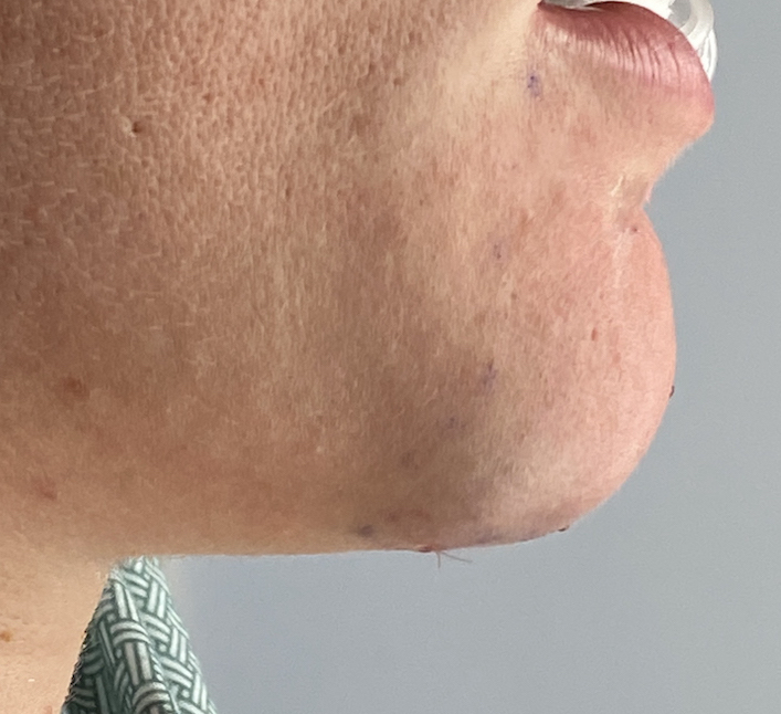 Plastic Surgery Case Study - Female Horizontal Chin Reduction with ...