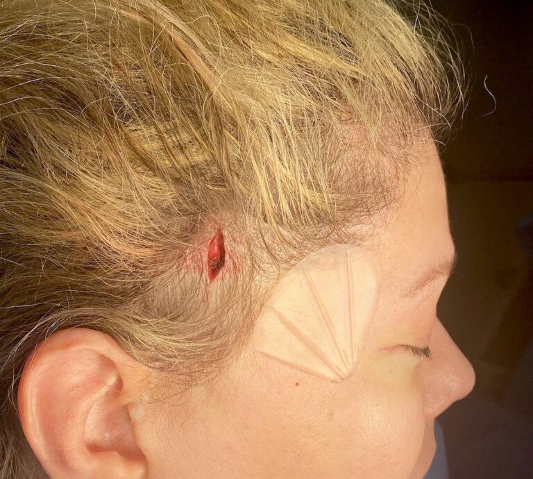 OR Snapshots - Temporal Implant Incisions - Explore Plastic Surgery