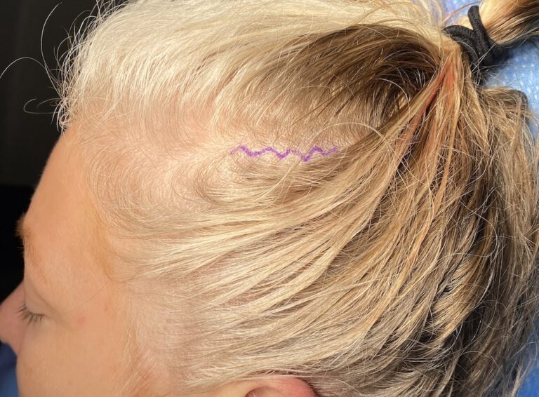 Plastic Surgery Case Study - Bilateral Parietal Eminence Skull ...