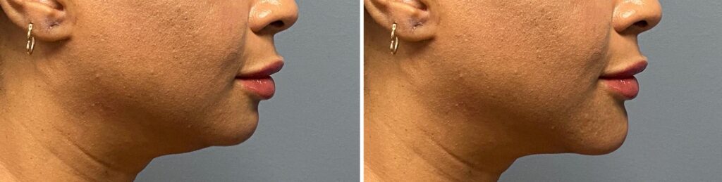 Plastic Surgery Case Study - Vertical Lengthening of the Short Female ...