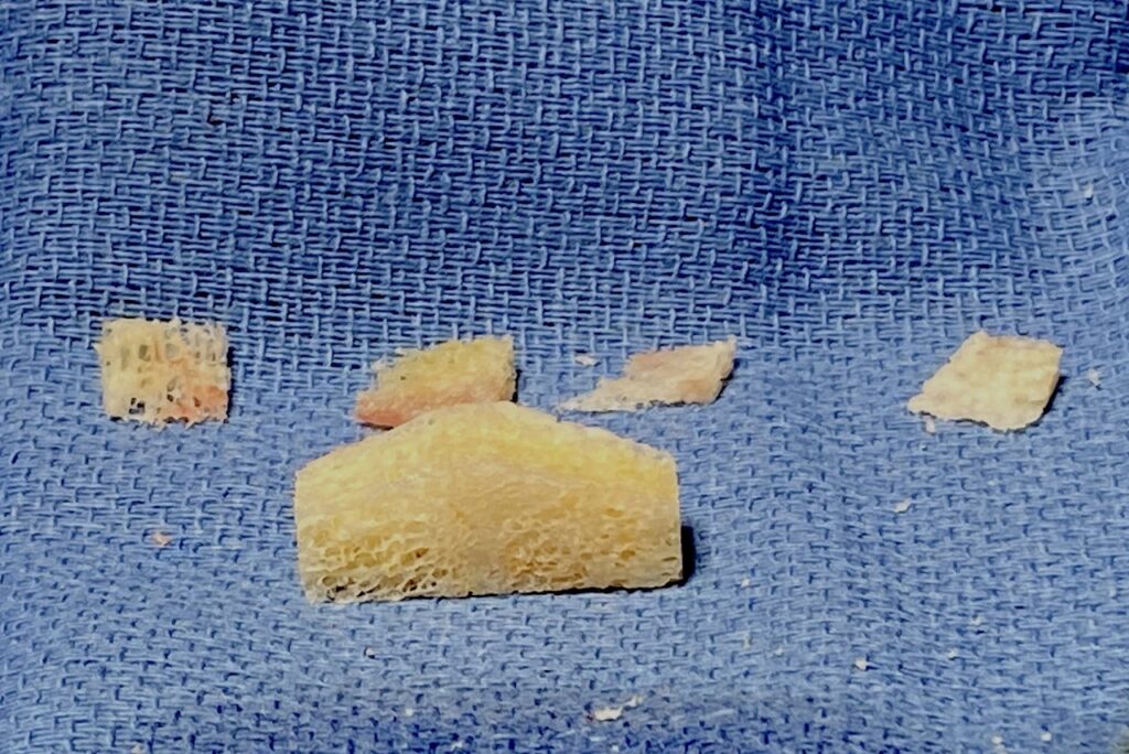 Assessment of Bone Healing Across The Grafts Interpositional Gap in ...