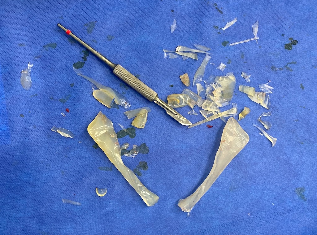 Technical Strategies - Intraoperative Hand Modification of Custom ...