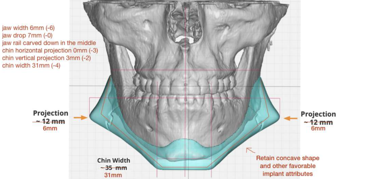 Technical Strategies - Intraoperative Hand Modification of Custom ...