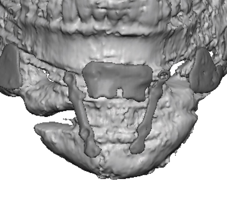 large vertical lengthening bony genioplasty 3D CT scan front view Dr ...