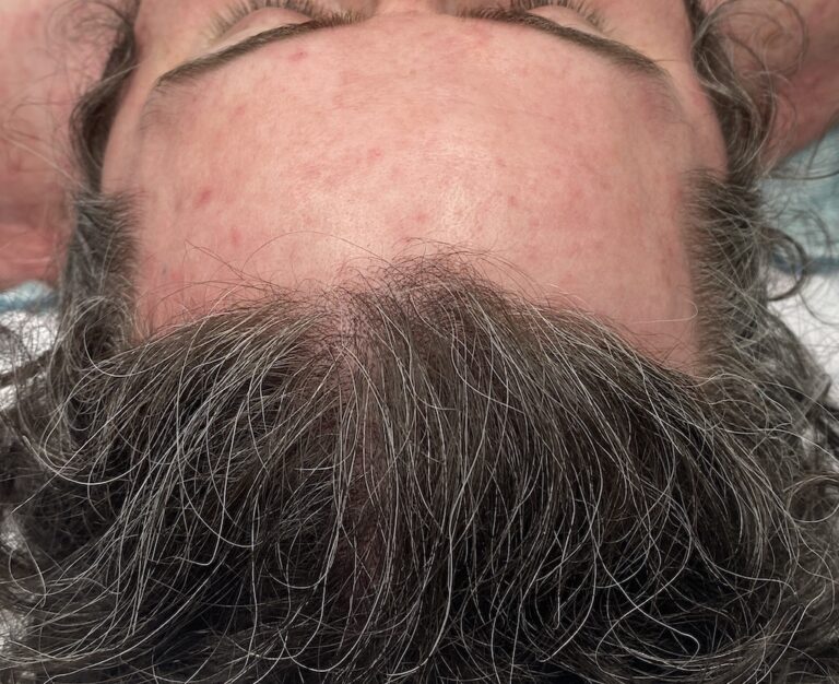 Plastic Surgery Case Study - Male Combined Frontal Bossing and Sagittal ...