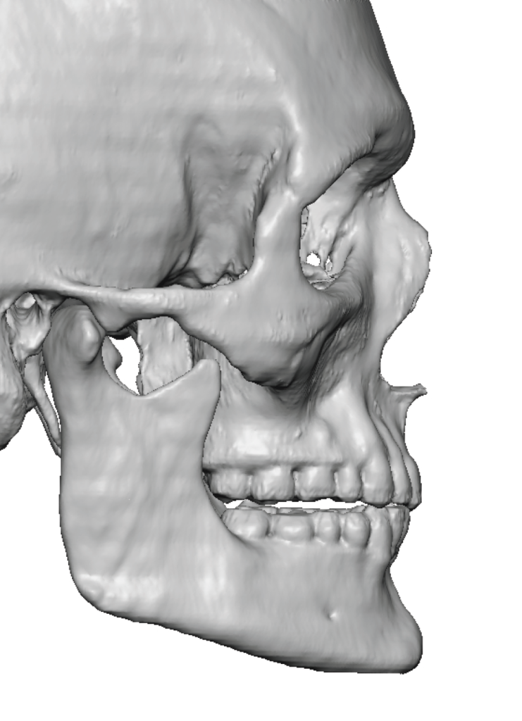 Plastic Surgery Case Study - Custom Jawline Implant Design with ...