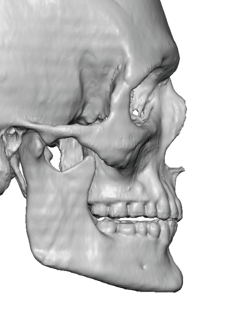 Plastic Surgery Case Study - Custom Jawline Implant Design with ...