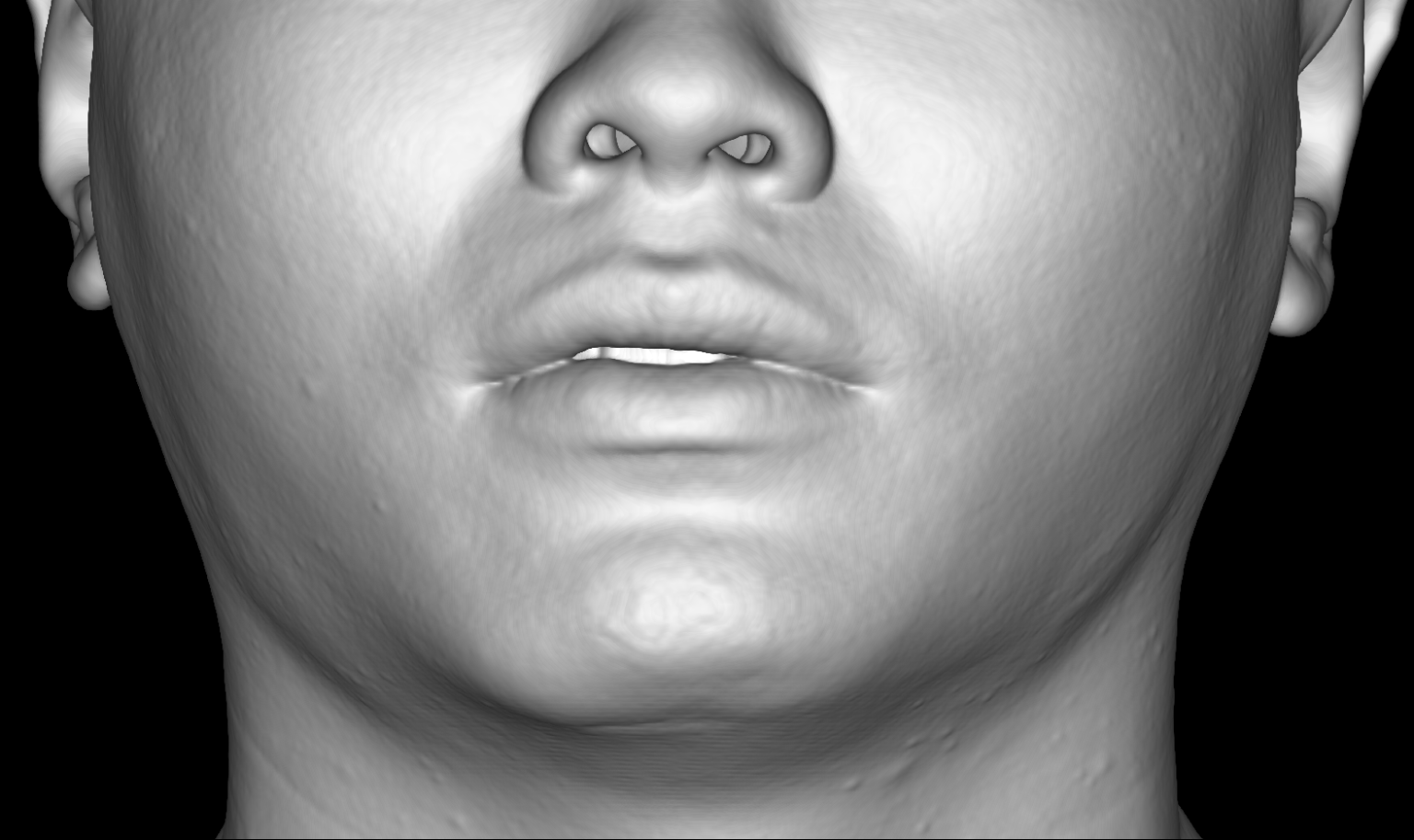Plastic Surgery Case Study - Secondary Chin Reshaping after Sliding ...