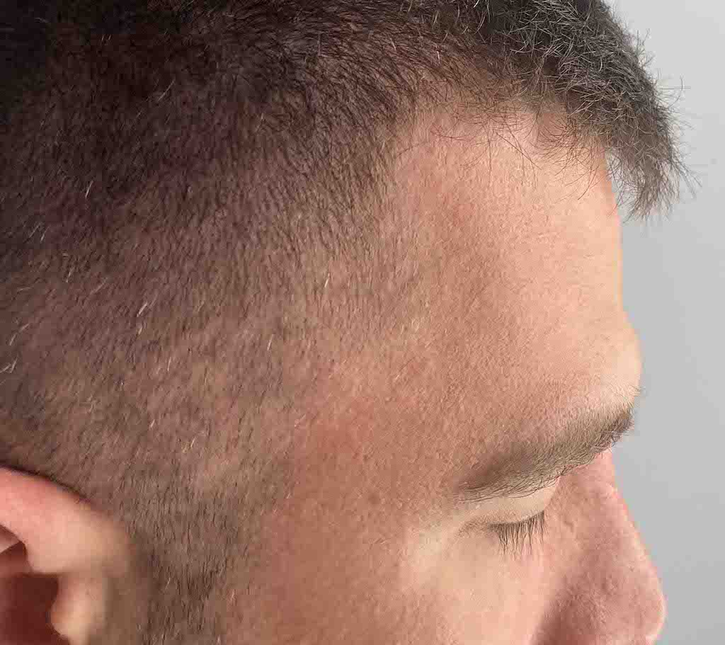 Plastic Surgery Case Study - Fat Injections for Softening the Male ...