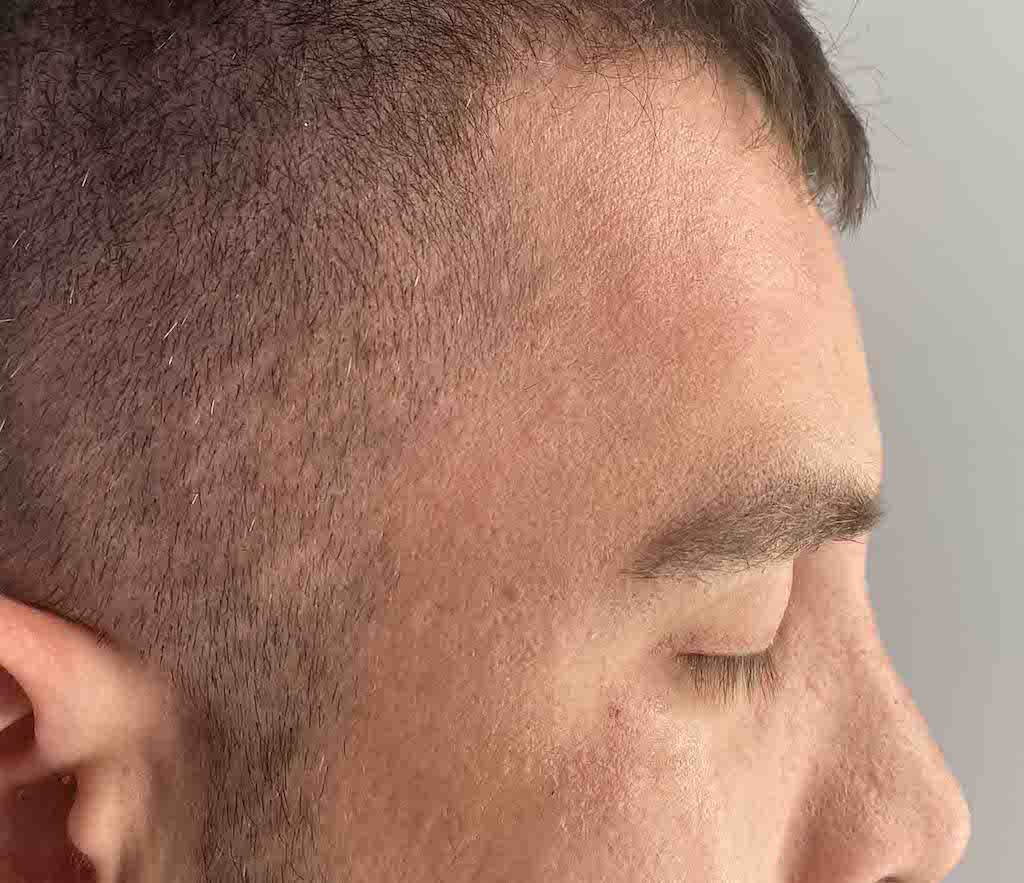 Plastic Surgery Case Study - Fat Injections for Softening the Male ...