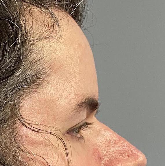 male forehead reduction side 2 closeup Dr Barry Eppley - Explore ...