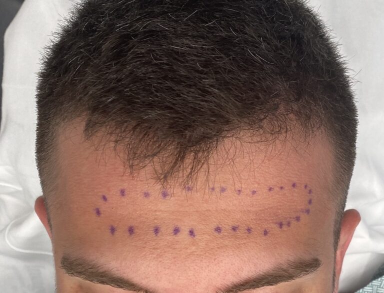 Plastic Surgery Case Study - Fat Injections for Softening the Male ...