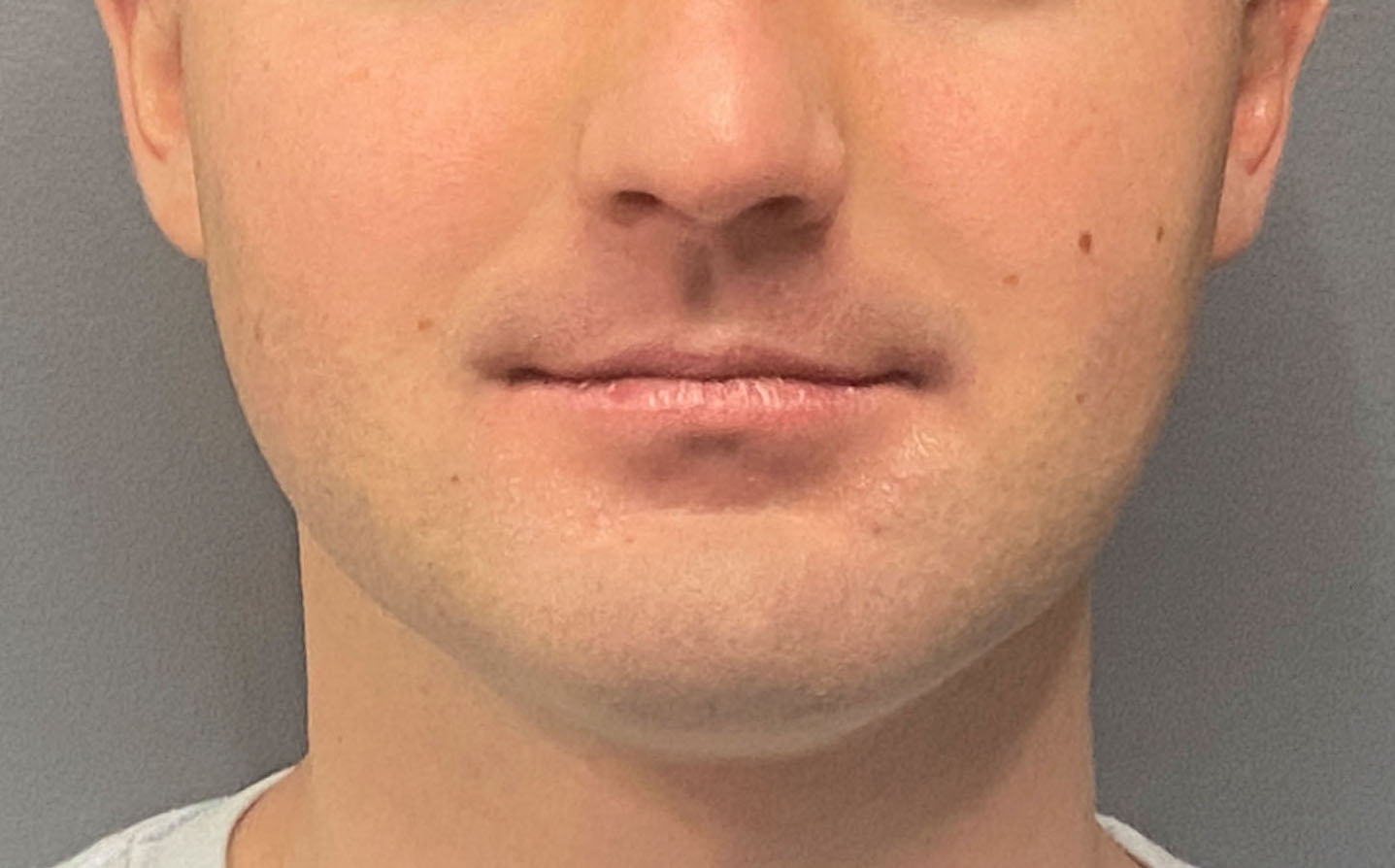 Plastic Surgery Case Study - Long Term Results of a Custom Jawline ...