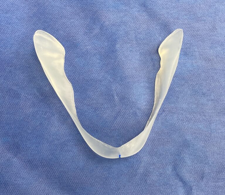 Plastic Surgery Case Study - Custom Jawline Implant Design with ...