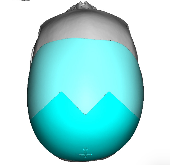 Plastic Surgery Case Study - The Two Stage Approach to Large Custom ...