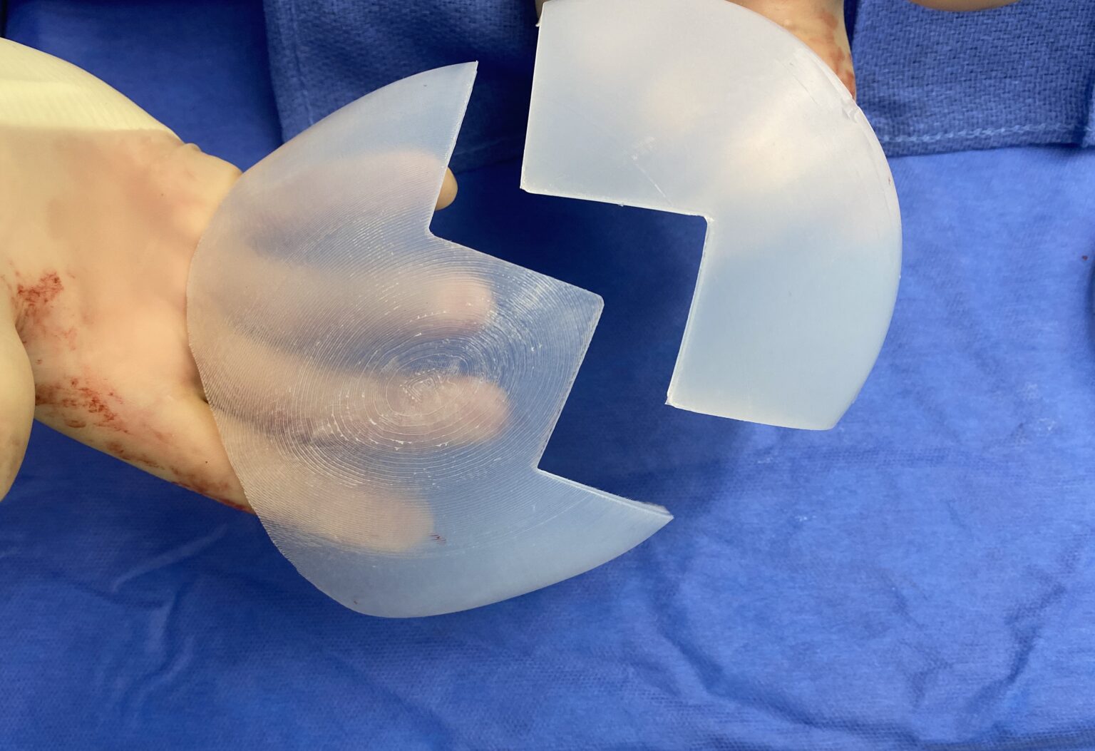 Plastic Surgery Case Study - The Two Stage Approach to Large Custom ...