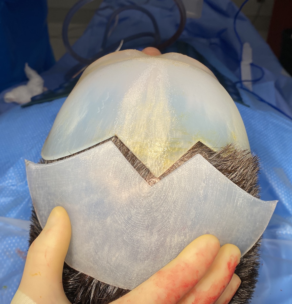 Plastic Surgery Case Study - Two Stage Custom Forehead Brow Bone ...