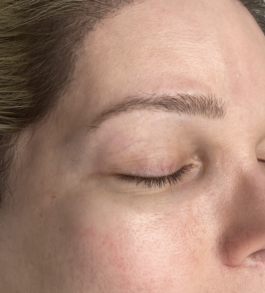 Technical Strategies - Treating the Cheek Implant Stepoff Deformity ...