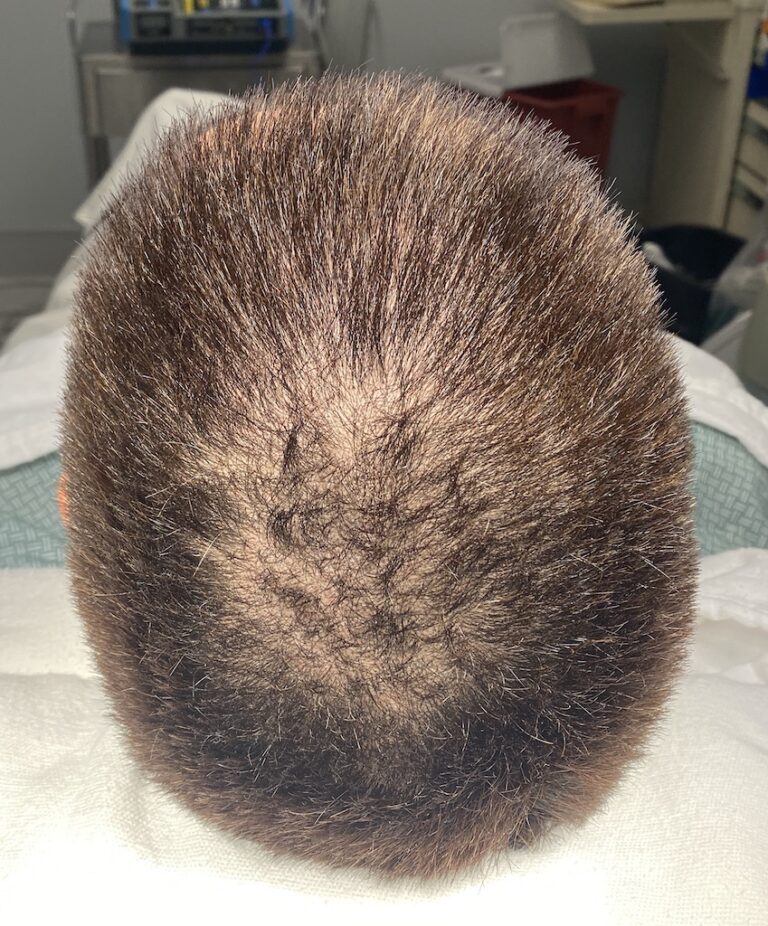 Plastic Surgery Case Study - Two Stage Custom Forehead Brow Bone ...