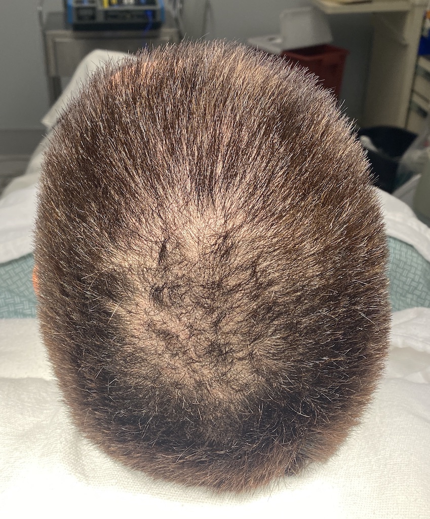 Plastic Surgery Case Study - Two Stage Custom Forehead Brow Bone ...