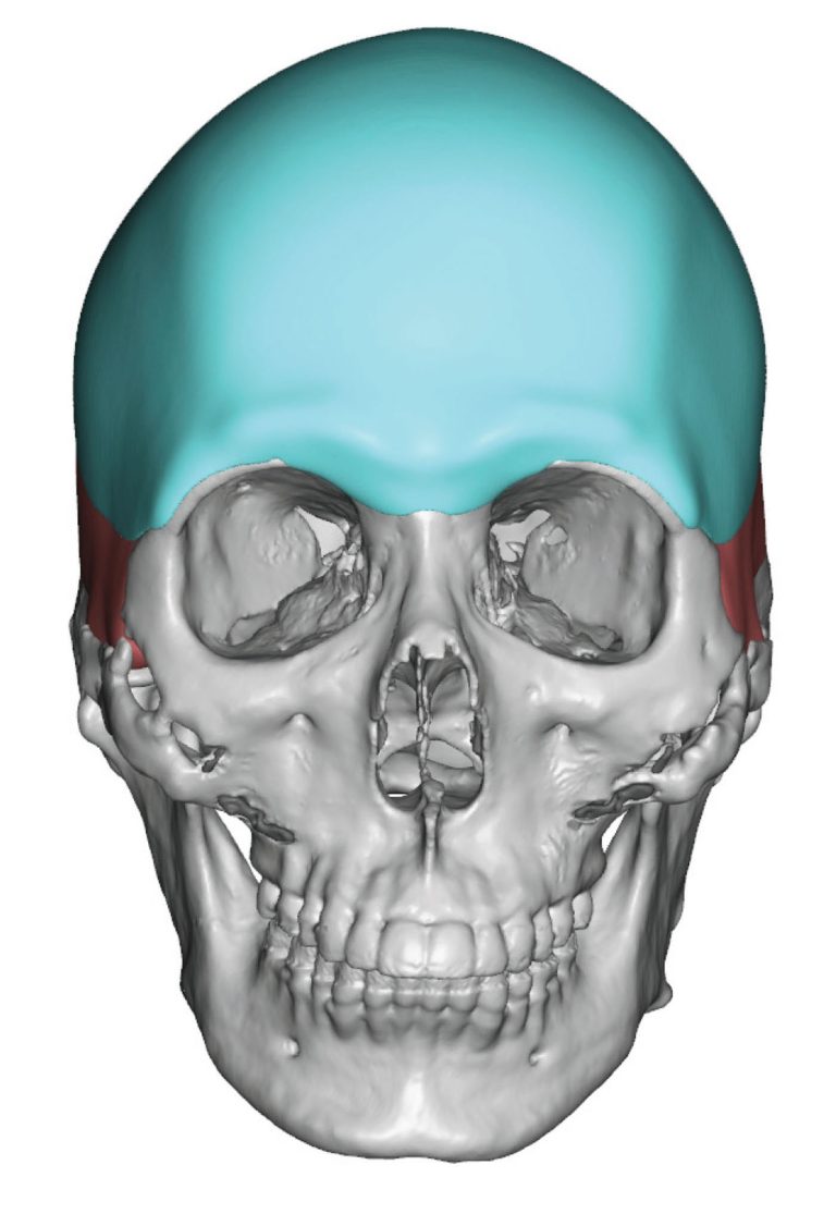 Plastic Surgery Case Study - Male Custom Forehead-Brow Bone-Temporal ...